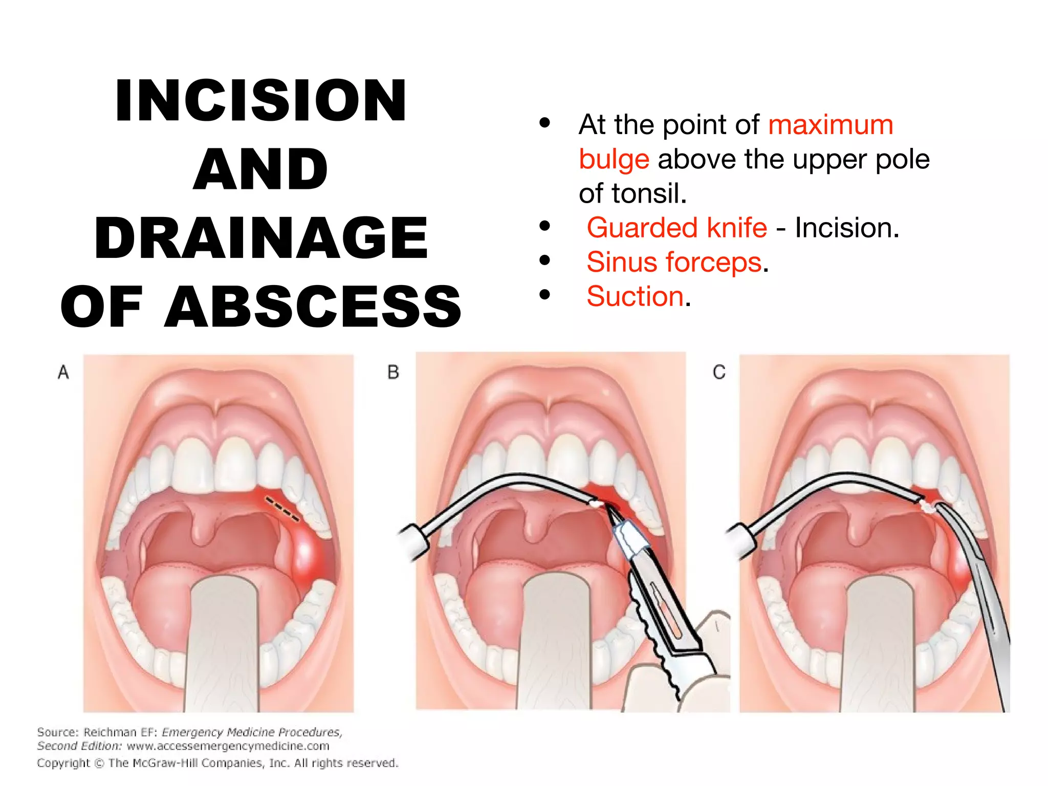 QUINSY (Peritonsillar Abscess) | PPT