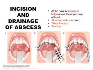 Peritonsillar Abscess Incision And Drainage