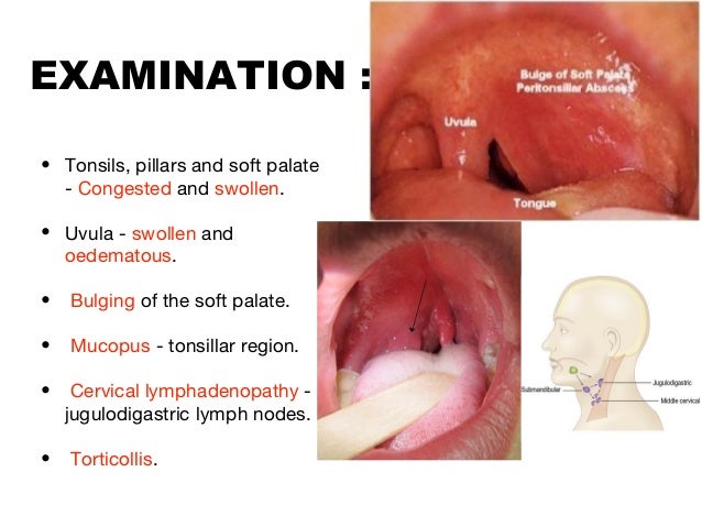 QUINSY (Peritonsillar Abscess)