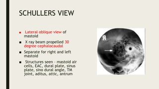 EAR NOSE THROAT BASIC RADIOLOGICAL INTERPRETATION RADIOLOGY.pptx