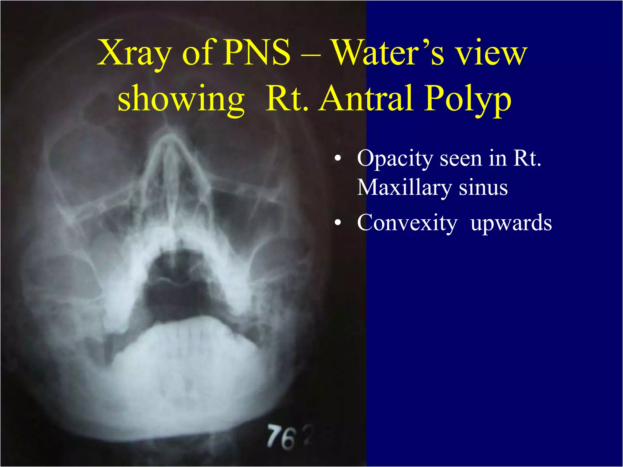 Ent radiology | PPTX