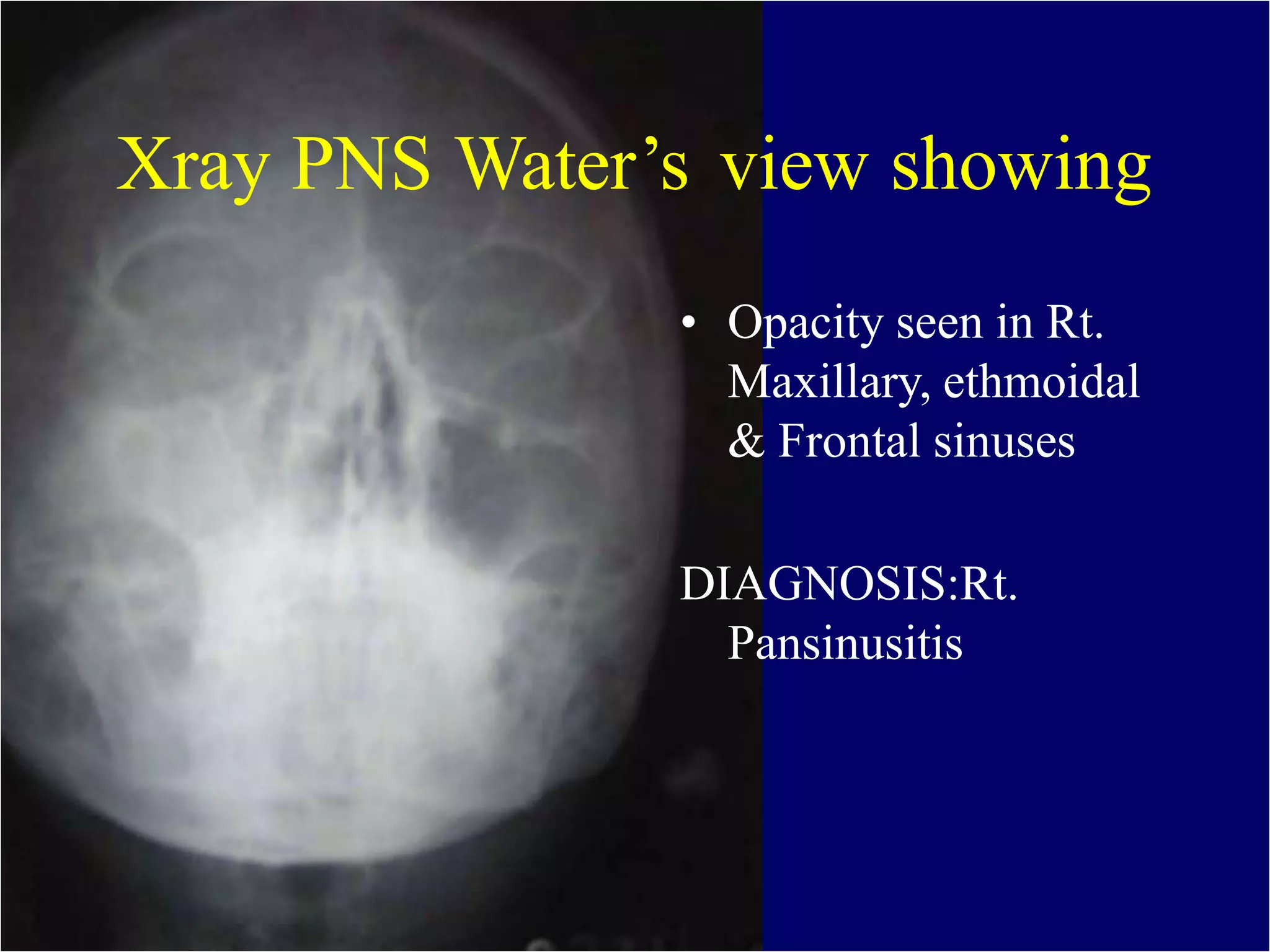 Ent radiology | PPTX