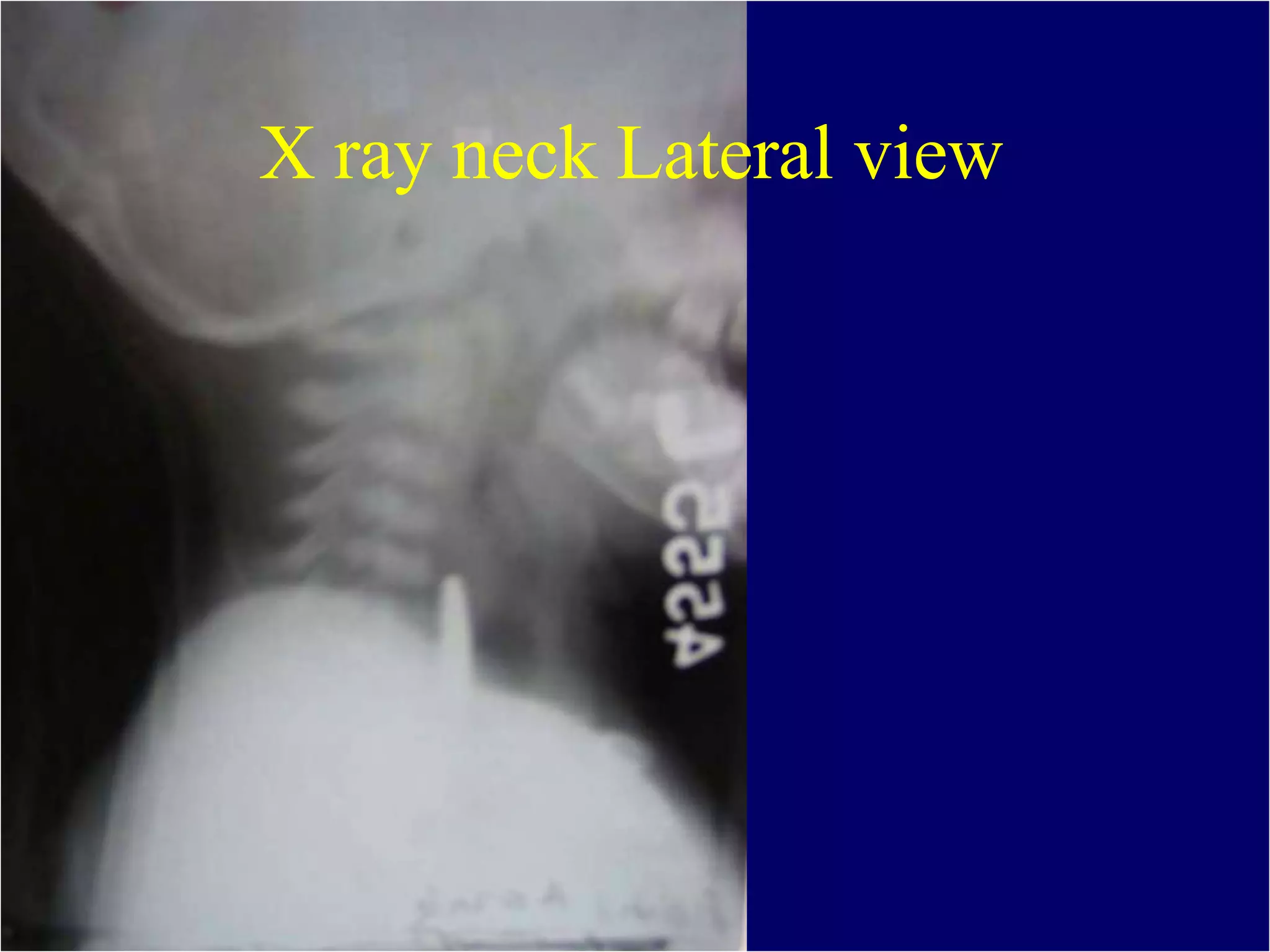 Ent radiology | PPTX