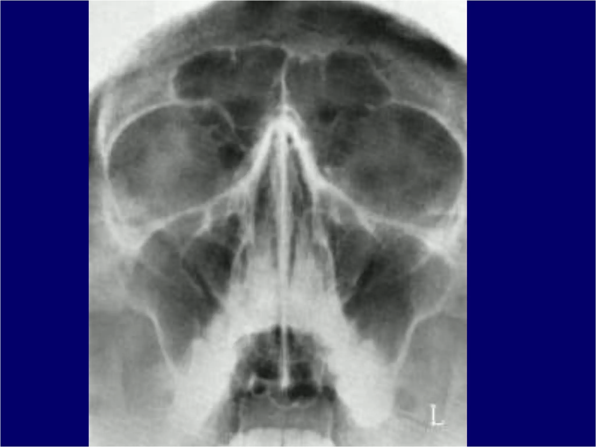 Ent radiology | PPTX