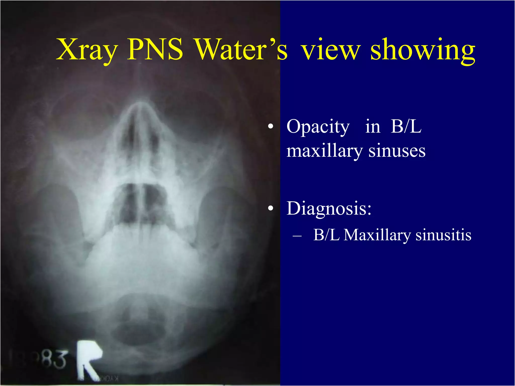 Ent radiology | PPTX