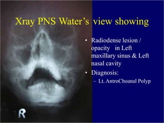 Ent radiology | PPTX