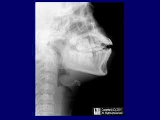 Ent radiology | PPTX