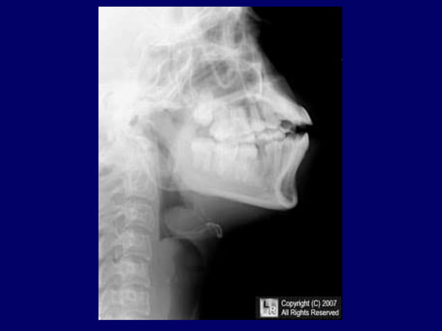 Ent radiology | PPTX