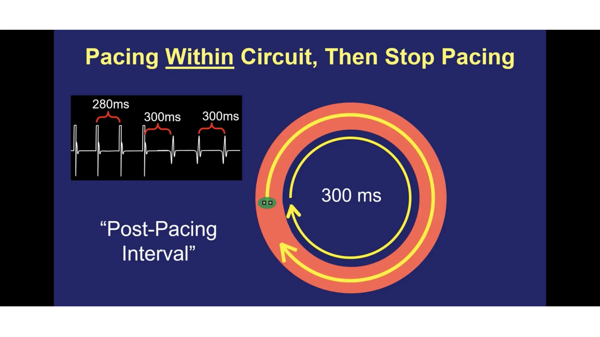 Cardiovascular Diseases - Electrophysiology - Entrainment.pptx