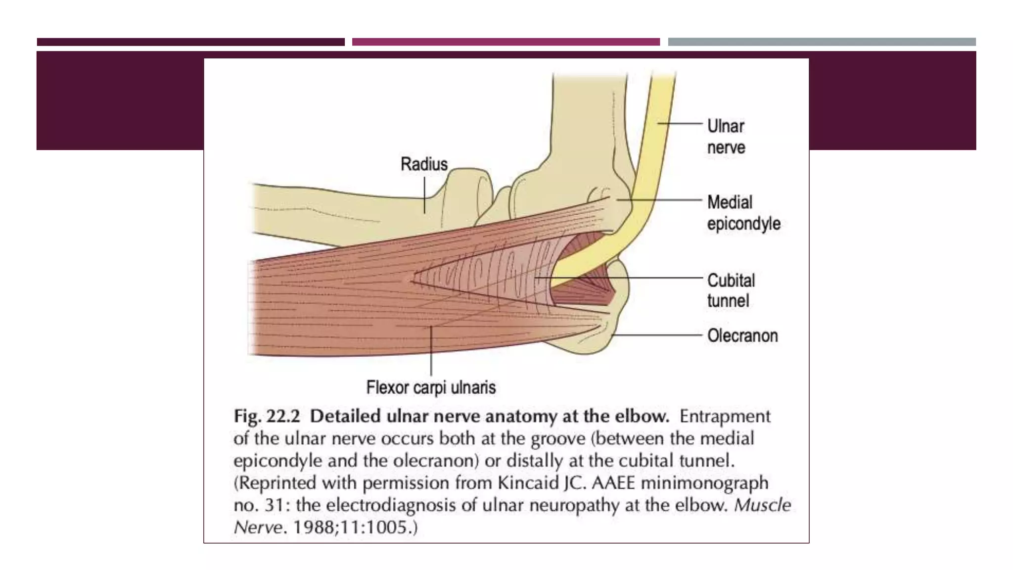Entrapment Neuropathies in Upper Limb.pptx