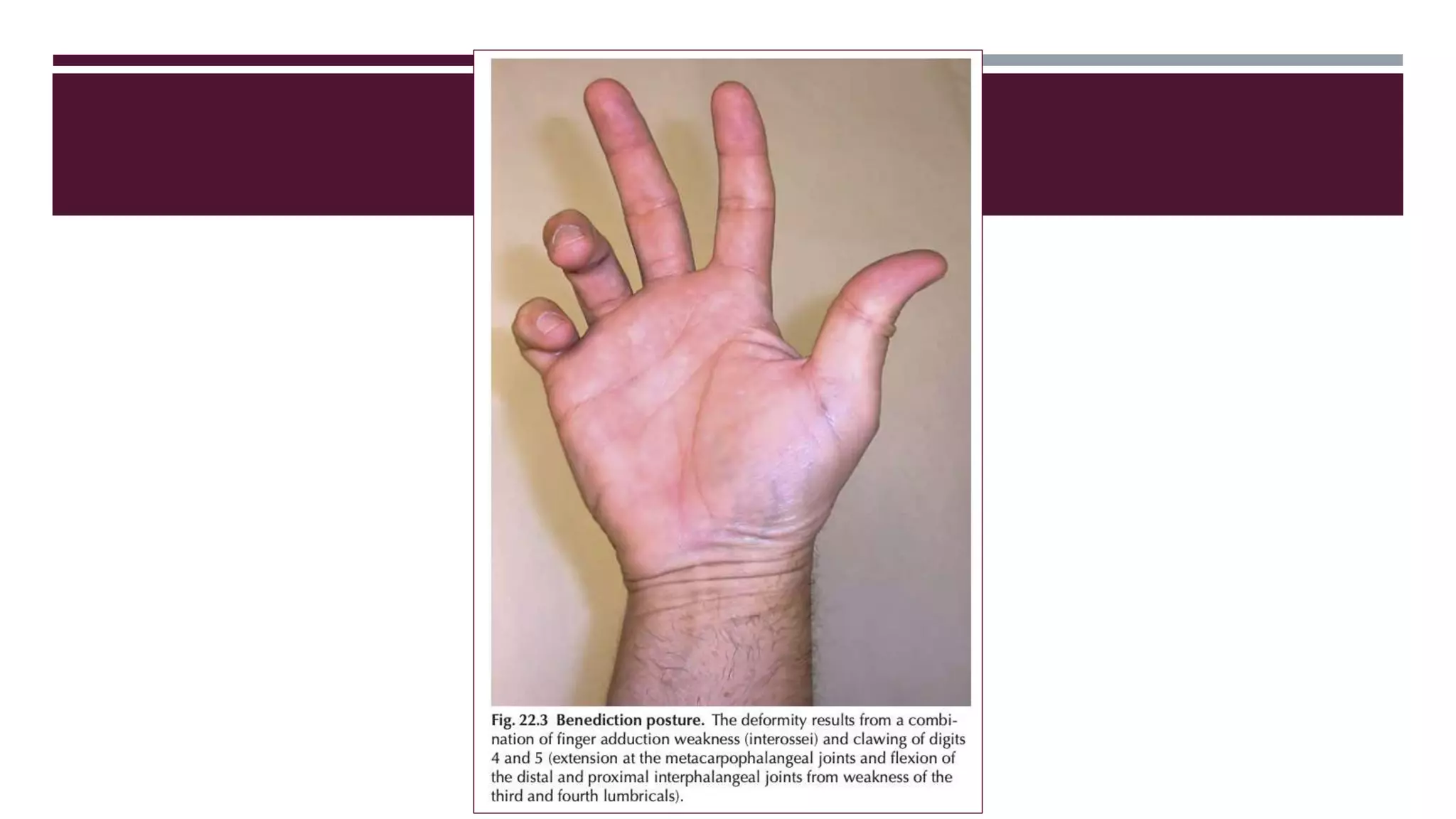Entrapment Neuropathies in Upper Limb.pptx