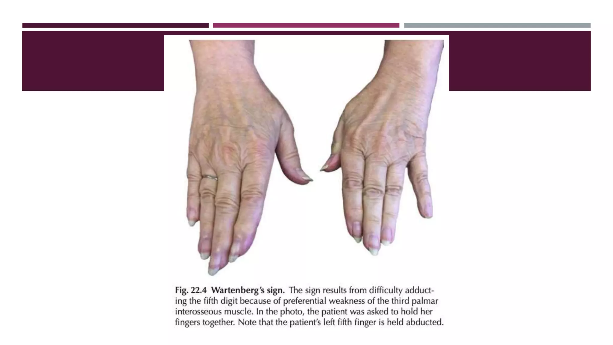 Entrapment Neuropathies in Upper Limb.pptx