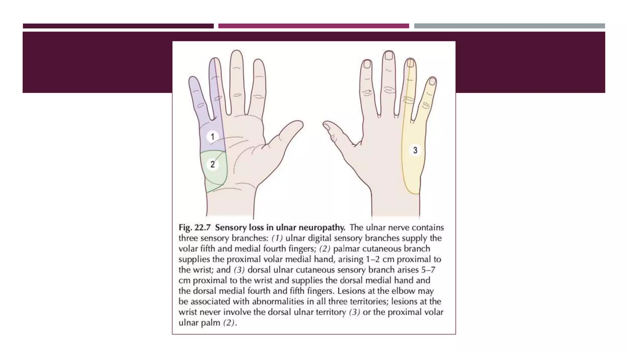 Entrapment Neuropathies in Upper Limb.pptx