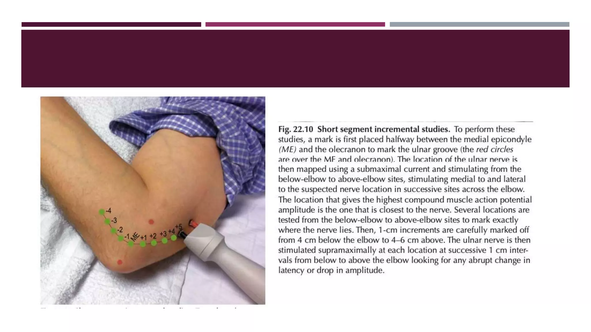 Entrapment Neuropathies in Upper Limb.pptx
