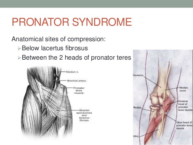 Entrapment neuropathy of the upper limb