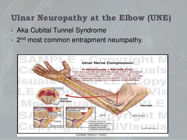 Cubital Tunnel Syndrome Aka Ulnar Nerve Entrapment Ask