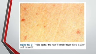 Entric Fever.pptx