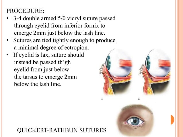 Entropion | PPTX | Eye and Vision Conditions | Diseases and Conditions