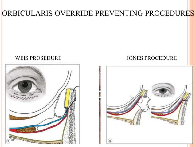 Entropion | PPTX | Eye and Vision Conditions | Diseases and Conditions