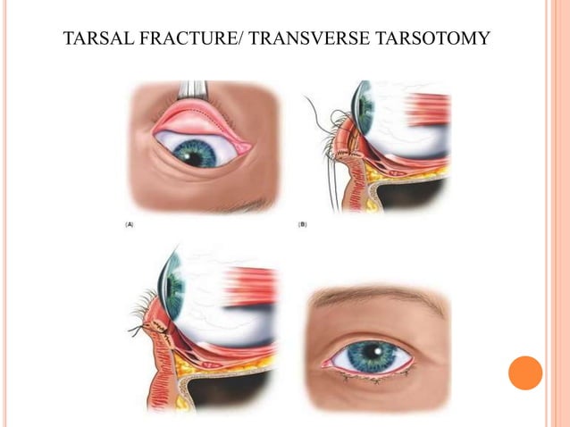 Entropion | PPTX | Eye and Vision Conditions | Diseases and Conditions