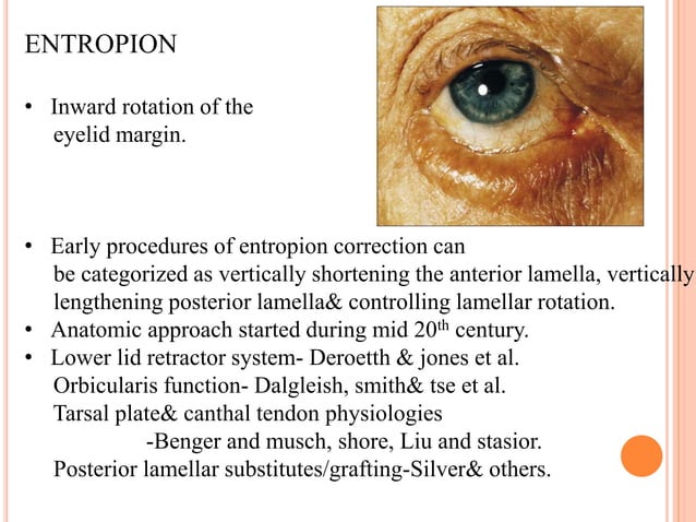 Entropion | PPTX | Eye and Vision Conditions | Diseases and Conditions