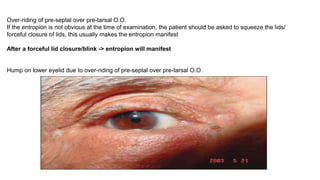 Involutional Entropion-mechanism, evaluation and management (lower lid ...