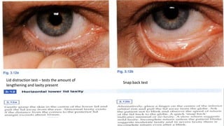 Involutional Entropion-mechanism, evaluation and management (lower lid ...