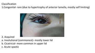Involutional Entropion-mechanism, evaluation and management (lower lid ...