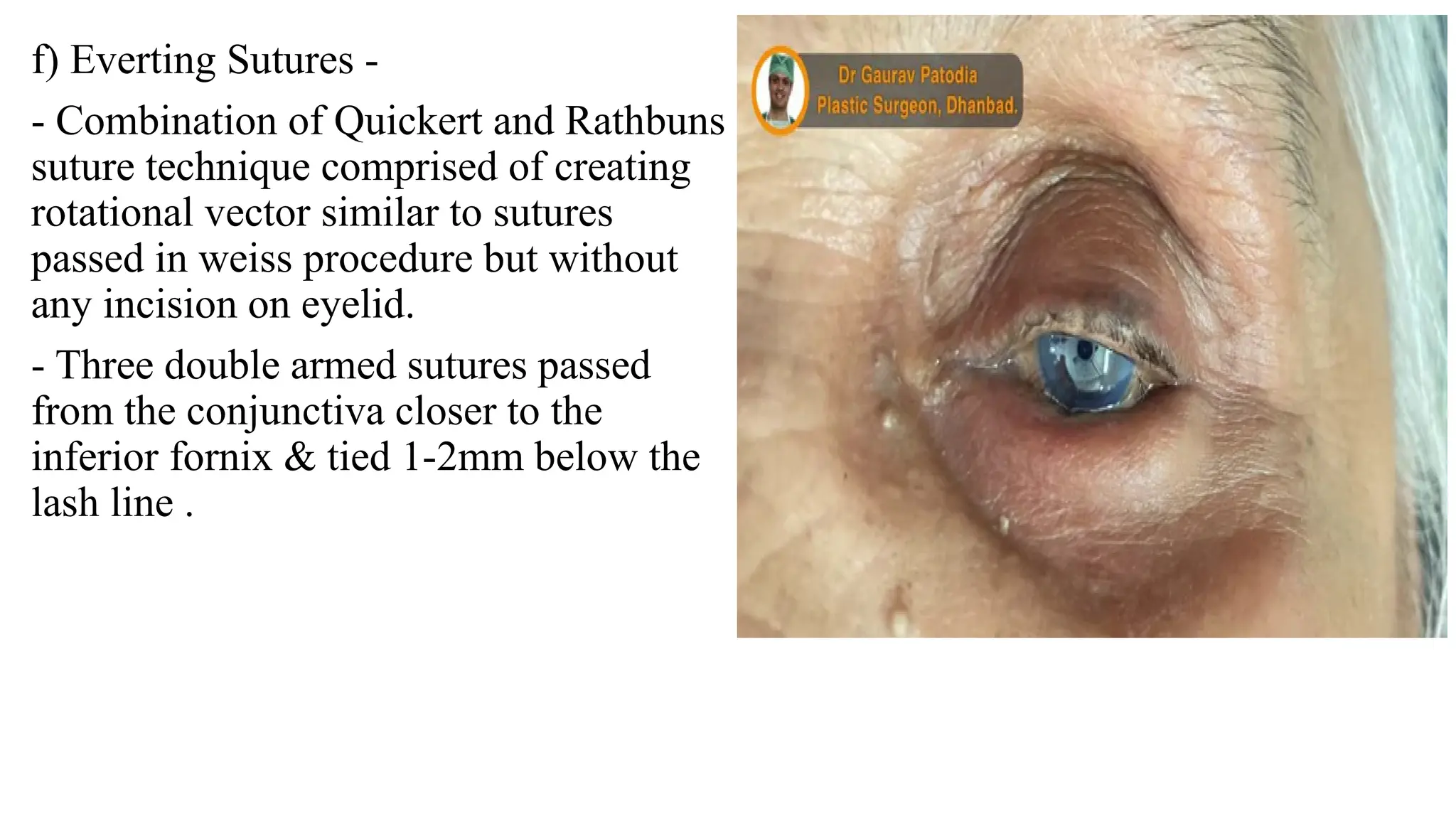 ENTROPION in detailed analysis and management | PPTX