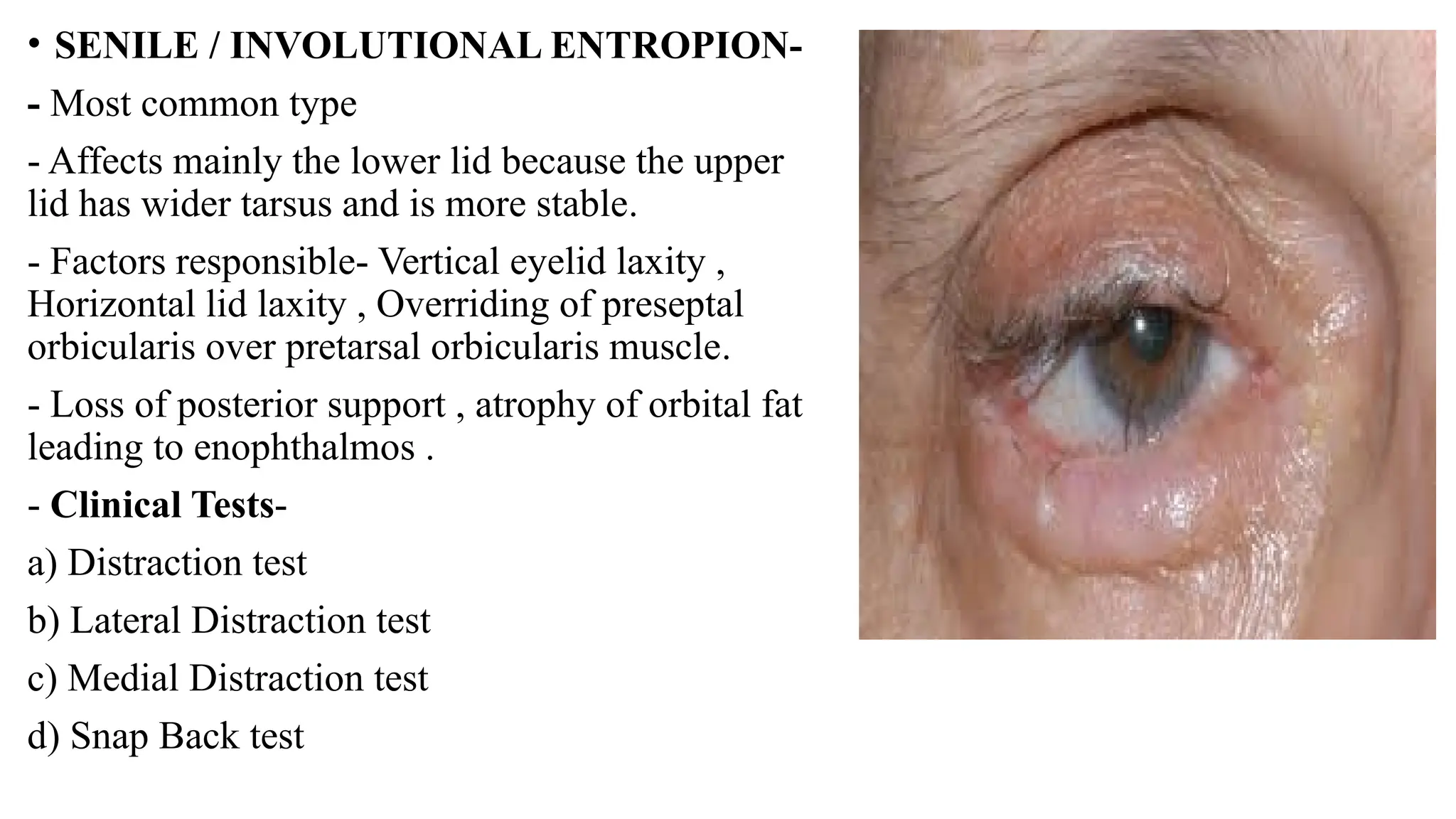 ENTROPION in detailed analysis and management | PPTX