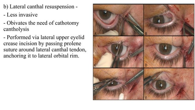 ENTROPION in detailed analysis and management | PPTX