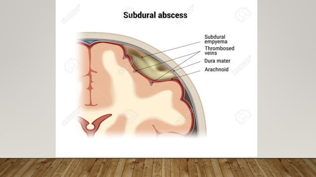 Complications Of Sinusitis Ent Pptx Free Download
