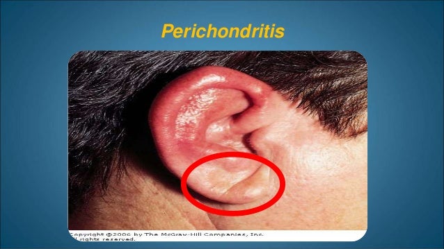 External Ear disease