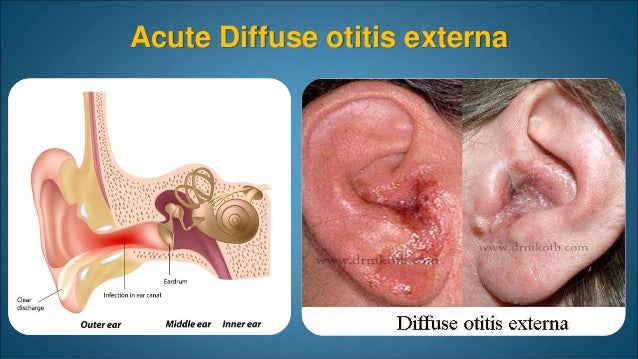 Diffuse Otitis Externa