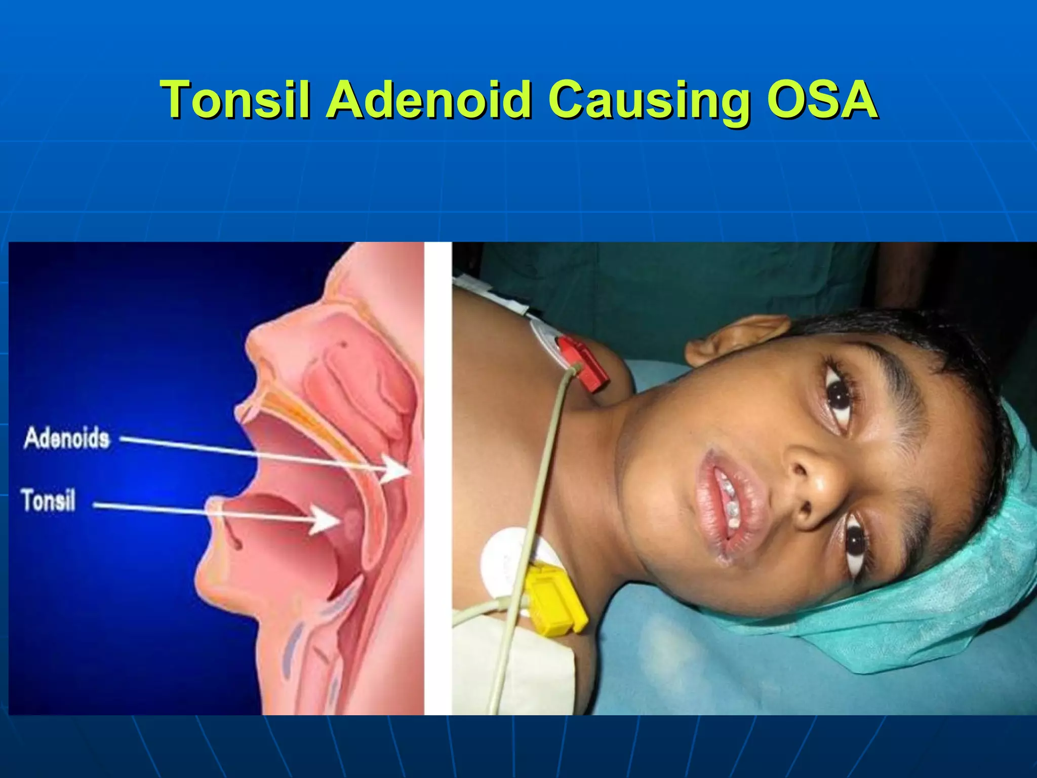Snoring and Obstructive Sleep Apnea:Management | PPT