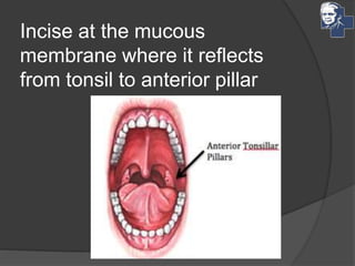 Management of Tonsillitis - Steps of tonsillectomy | PPTX