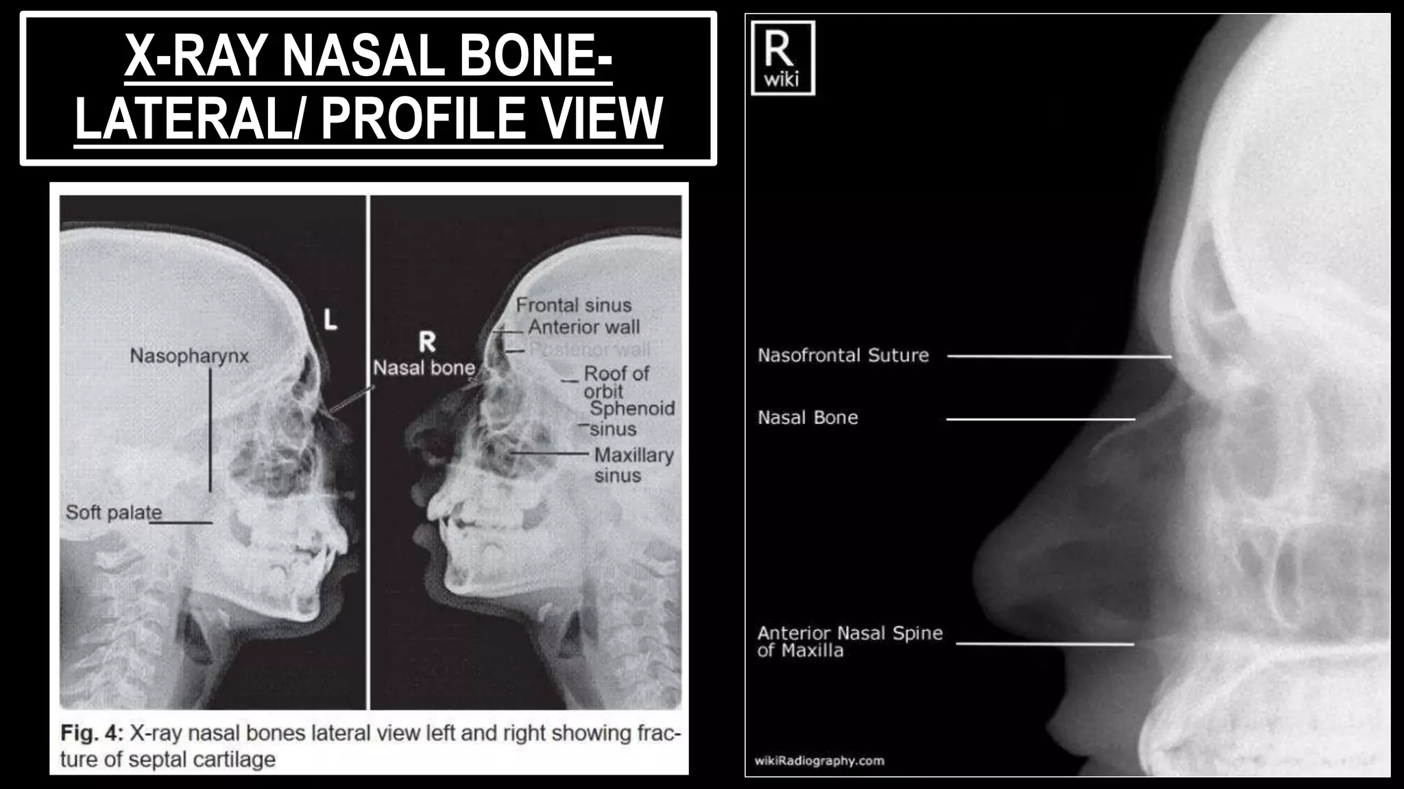 ENT X-RAYS | PPTX