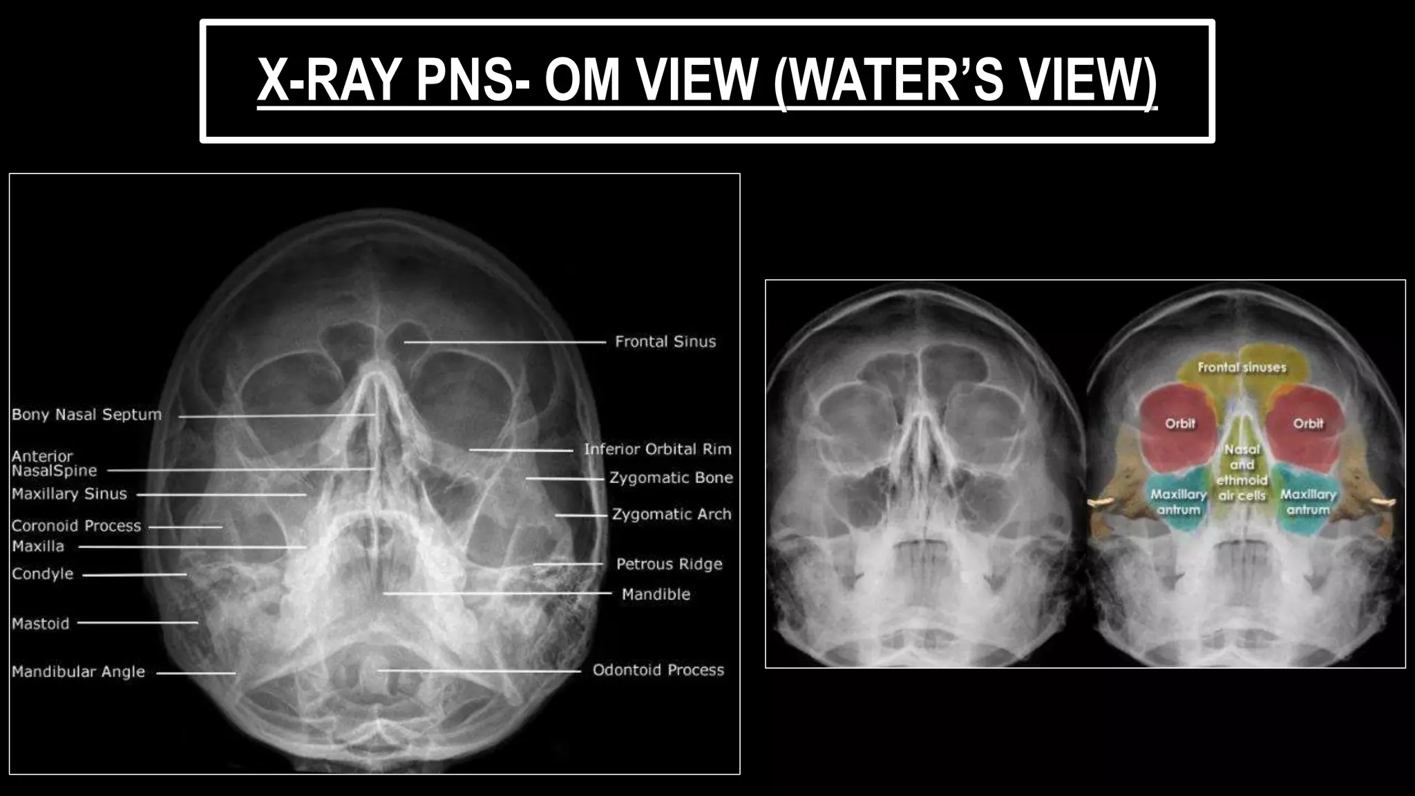 Ent X Rays Pptx