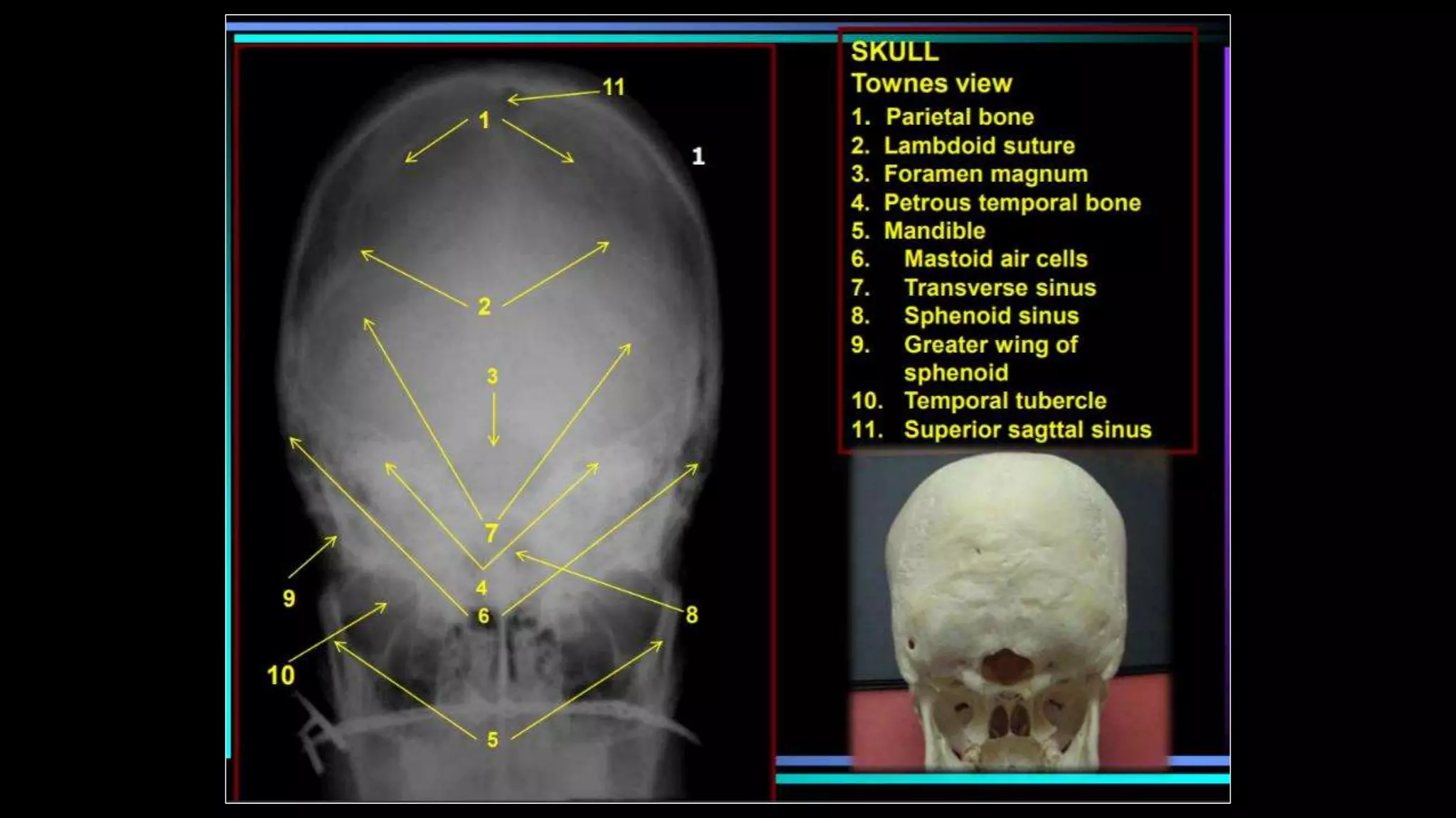 ENT X-RAYS | PPTX
