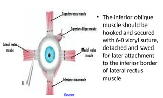 Enucleation : Surgical procedure (Oculoplasty) | PPTX