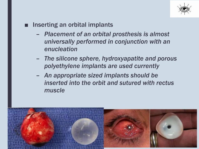 Enucleation and evisceration | PPT