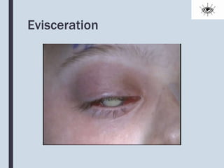 Enucleation and evisceration | PPTX