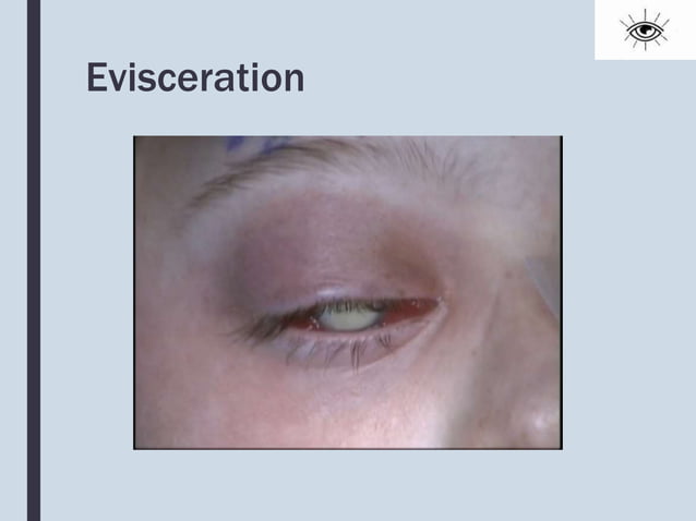 Enucleation and evisceration | PPTX | Eye and Vision Conditions ...