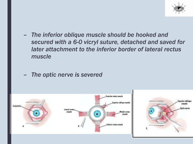 Enucleation and evisceration | PPTX | Eye and Vision Conditions ...