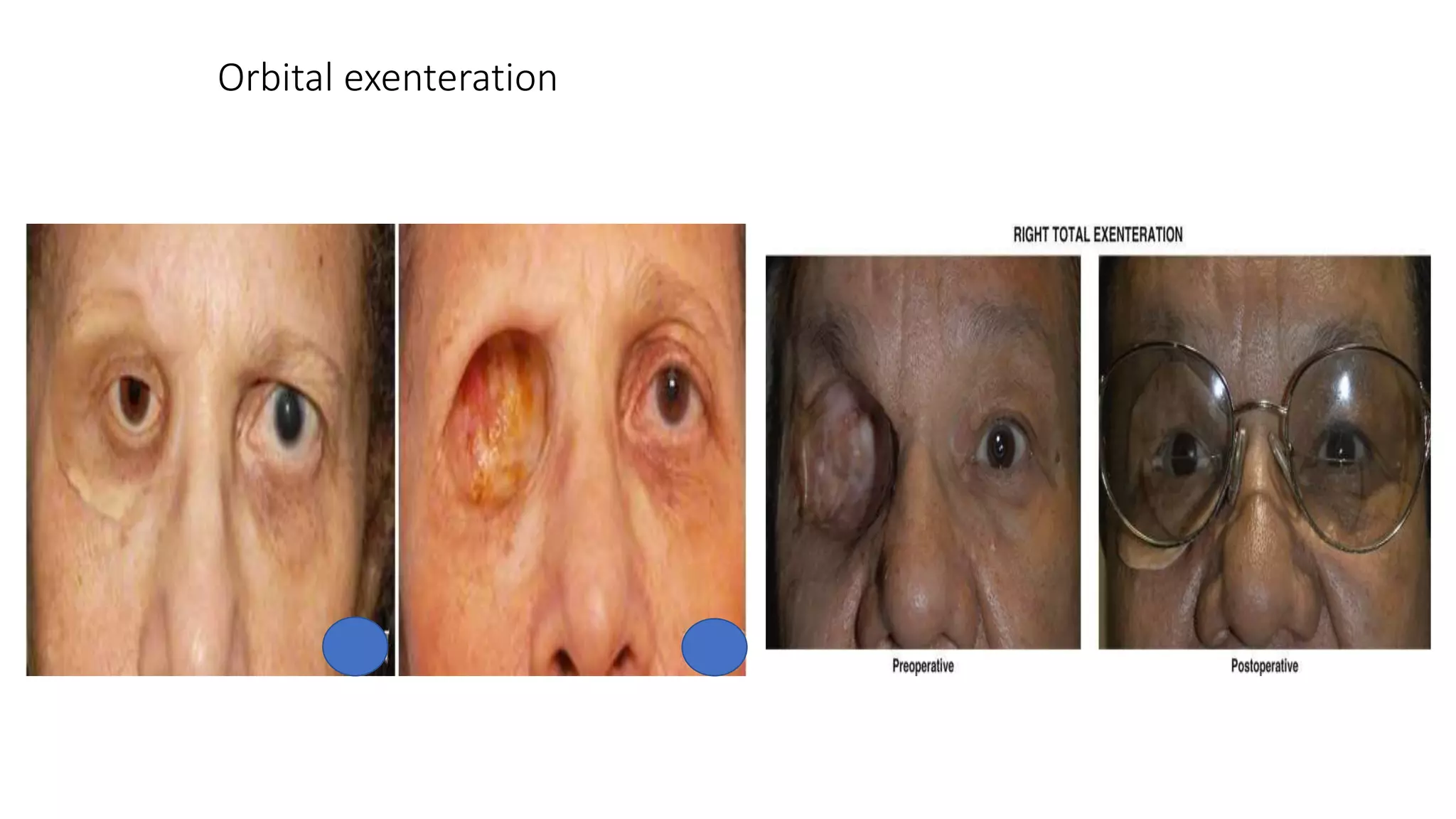 Enucleation, evisceration, exenteration | PPTX