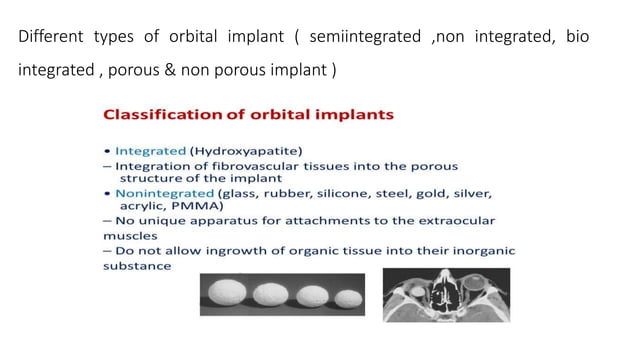 Enucleation, evisceration, exenteration | PPTX | Eye and Vision ...