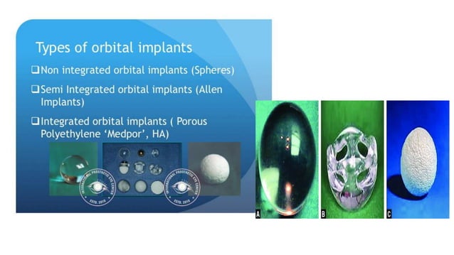 Enucleation, evisceration, exenteration | PPTX | Eye and Vision ...