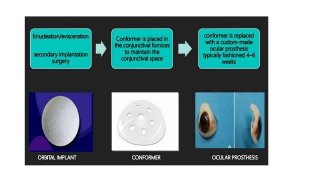 Enucleation, evisceration, exenteration | PPTX | Eye and Vision ...