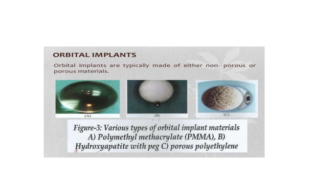 Enucleation, evisceration, exenteration | PPTX | Eye and Vision ...