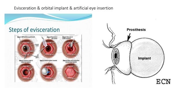 Enucleation, evisceration, exenteration | PPTX | Eye and Vision ...